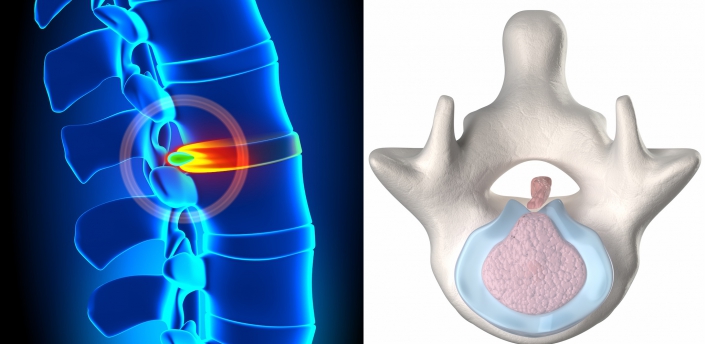 Discusprolaps (hernia nuclei pulposi)